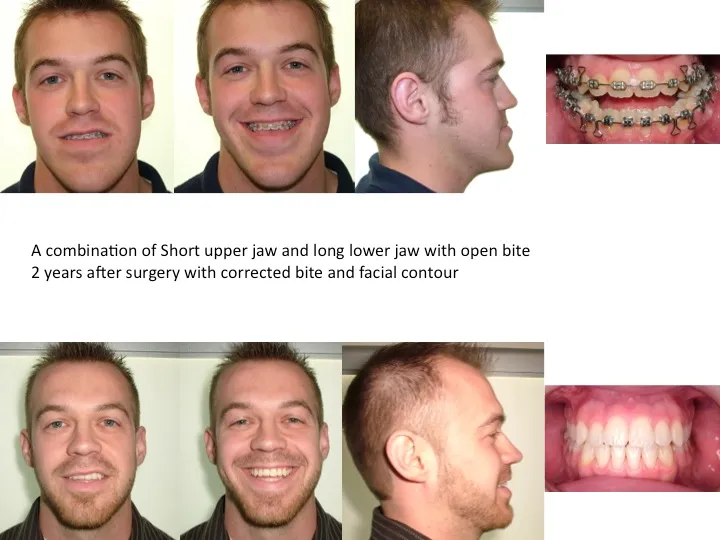 Maxillary Surgery Before And After
